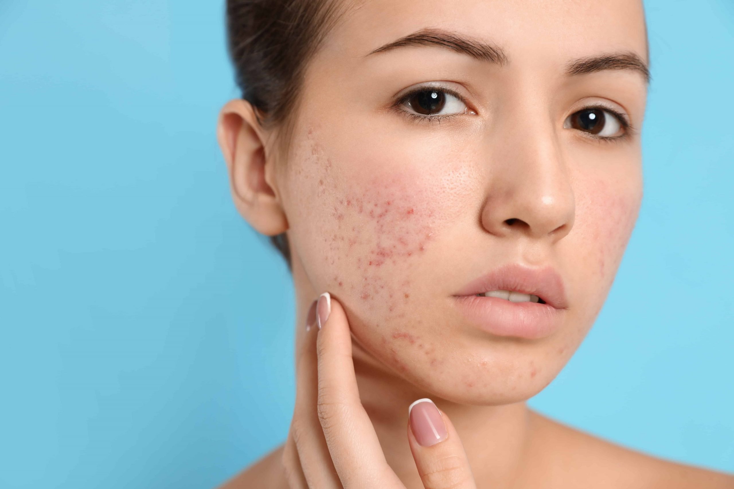 A Complete Guide To Acne Remedies Causes And Types Health Tenfold A Complete Guide To Acne Remedies Causes And Types Health Tenfold