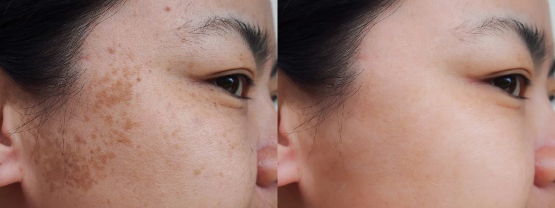 What Causes Skin Tags? Prevention and Treatment - Health Tenfold