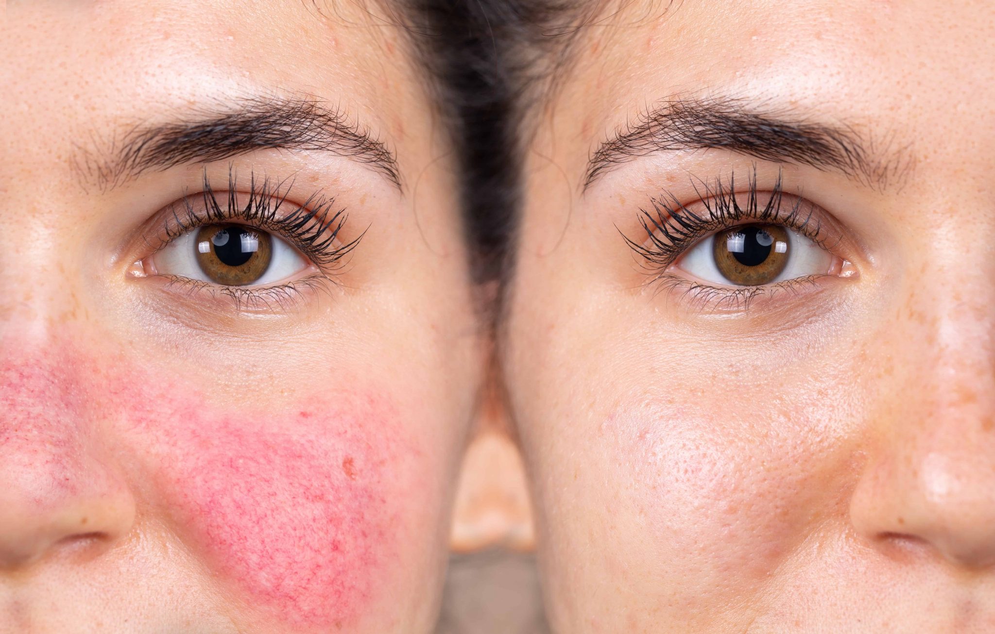 How to Treat Rosacea: Symptoms, Causes, and Treatment Options - Health ...