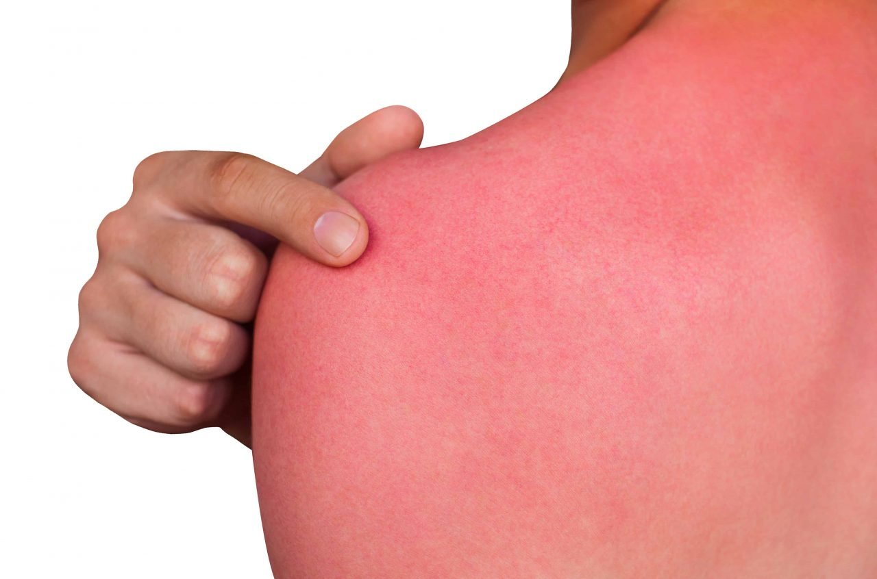 How to Treat Sunburn in 2020: Natural Remedies that offer immediate ...