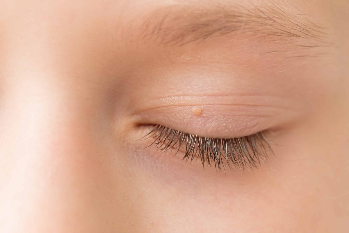 Warts On The Face Get Rid Of Them Now Health Tenfold Warts On The Face Get Rid Of Them Now Health Tenfold