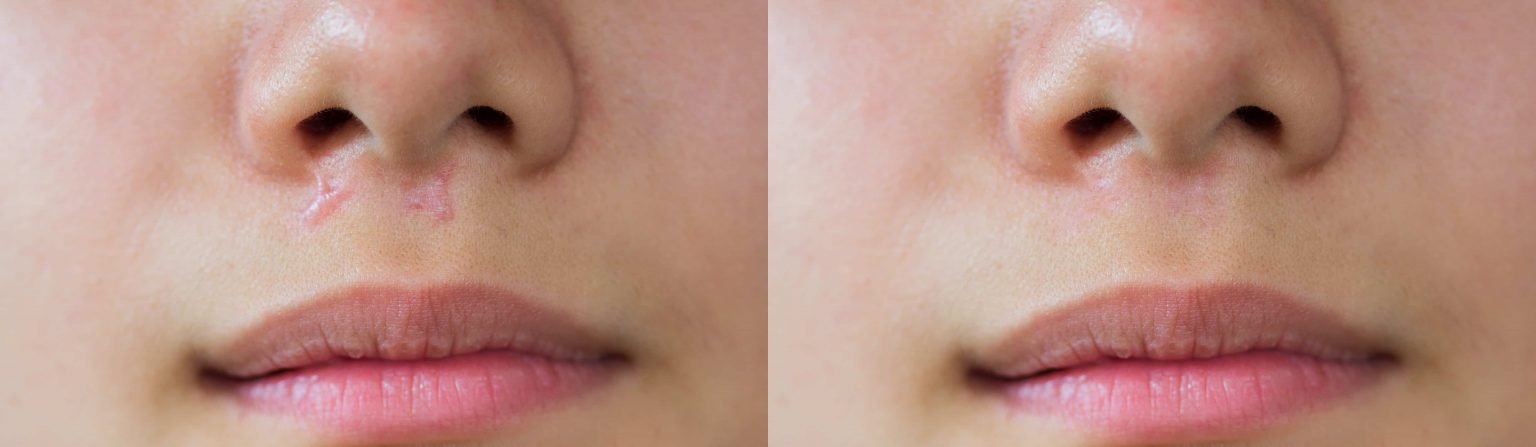 Hypertrophic Scars - What Are They and How to Get Rid of Them - Health ...