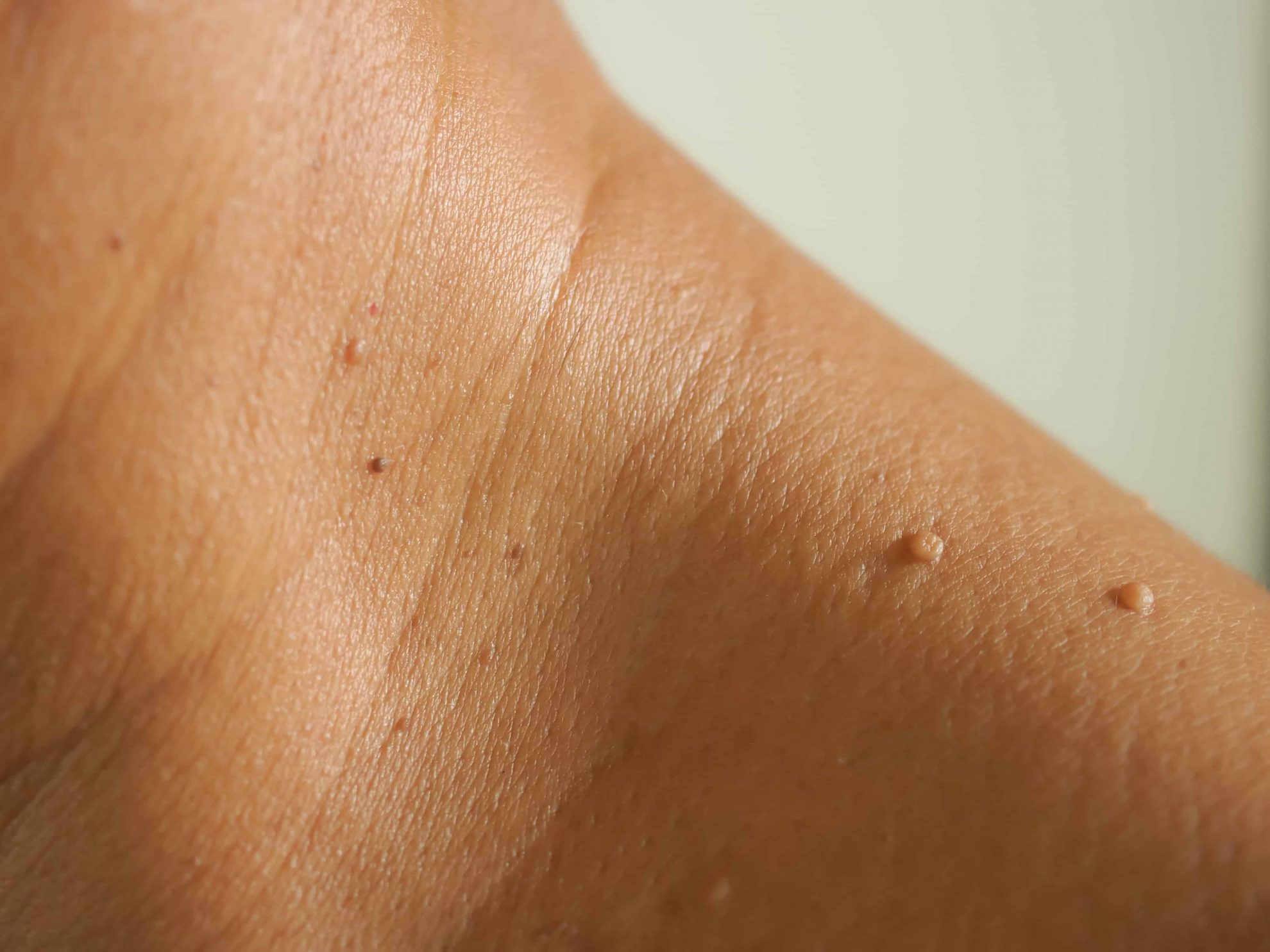 What Causes Skin Tags on Neck? | Health Tenfold