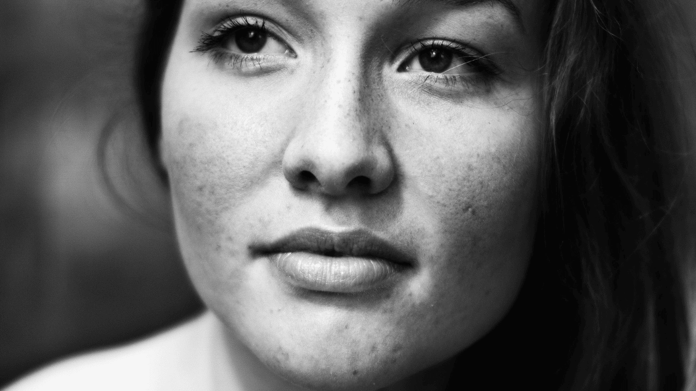 Is Itchy Acne a Sign of Healing? Unveiling the Truth Behind the ...