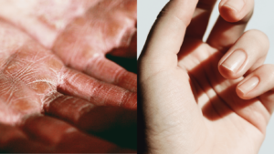 Eczema vs Scabies: Understanding the Key Differences - Health Tenfold